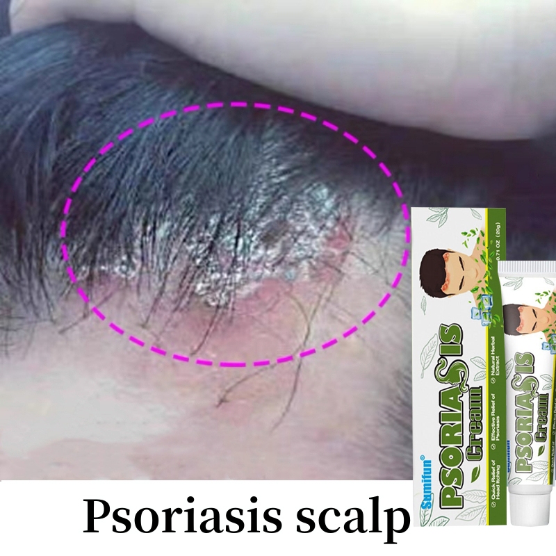 Jual [100% Asli] Salep kulit Krim psoriasis paling ampuh 20g Salep ...