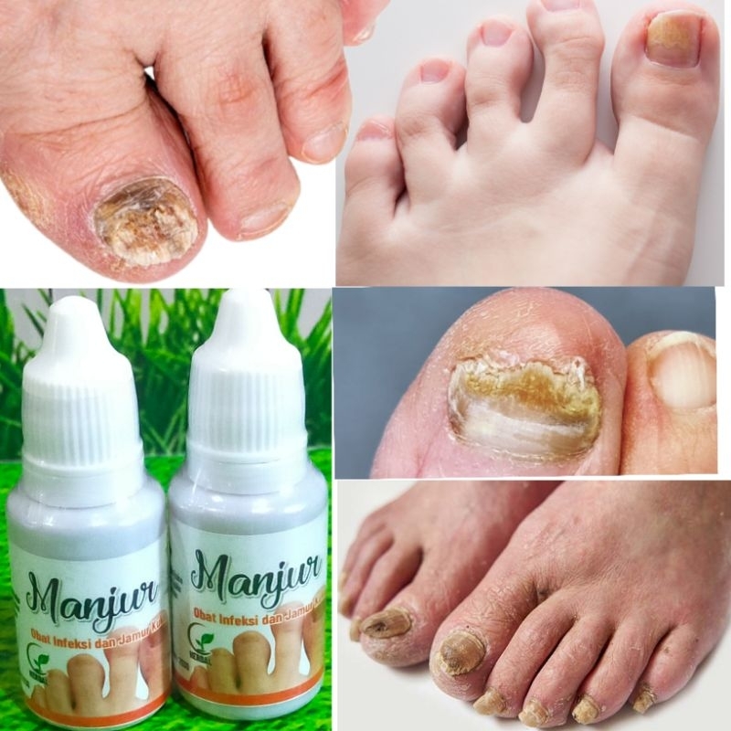 Jual OBAT KUKU CANTENGAN INFEKSI JAMUR DAN BAKTERI GATAL BAU BERNANAH ...