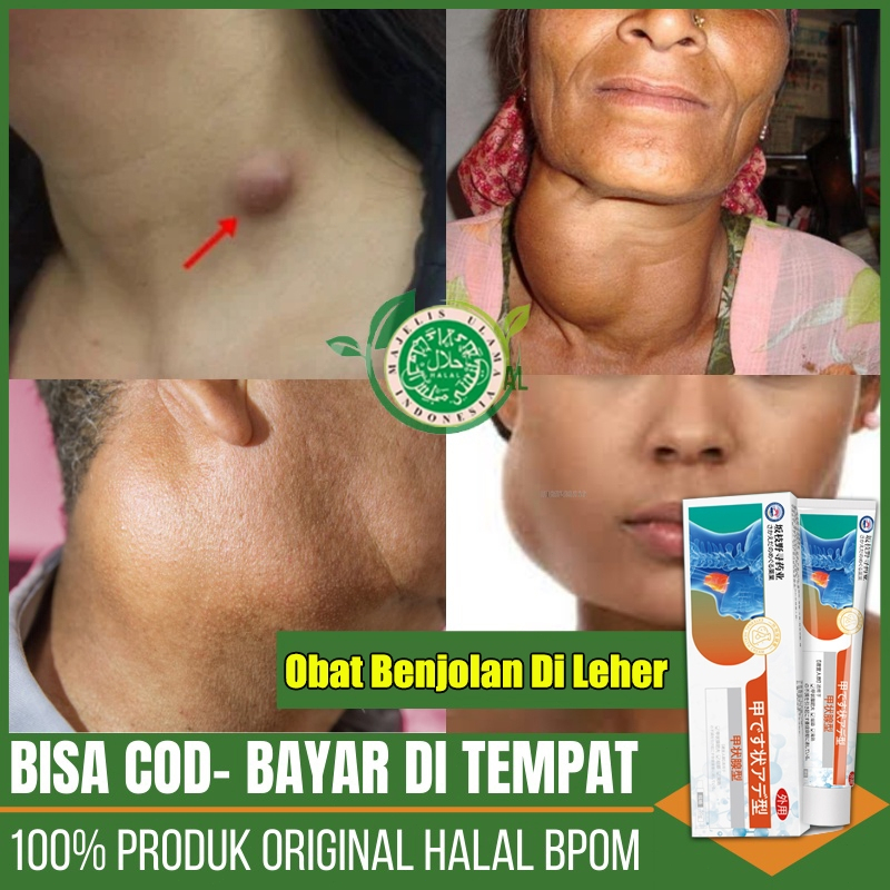 Jual Obat Benjolan Krim Tiroid Obat Gondok Kelenjar Tiroid 20g Obat ...