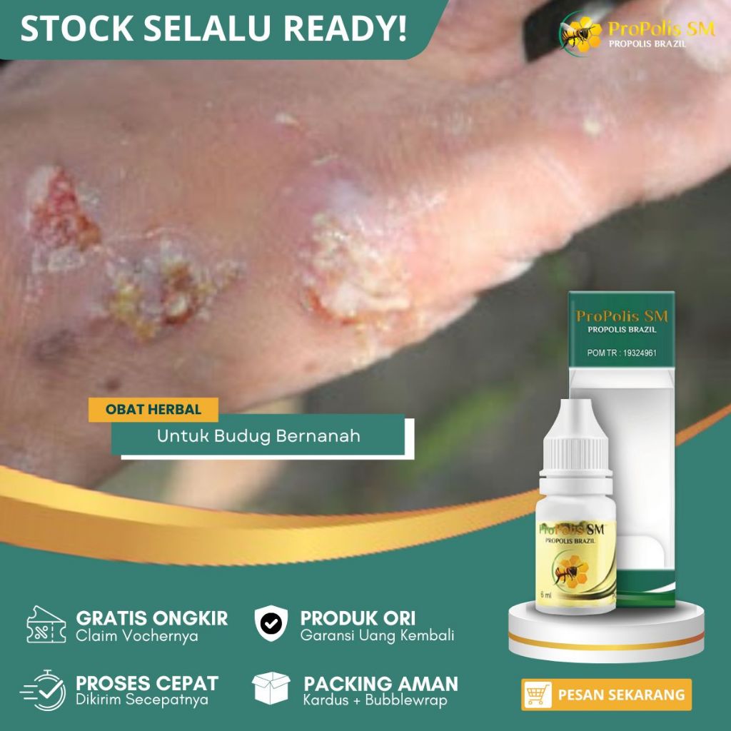 Jual Obat Budug Bernanah, Gatal Bernanah, Cenang Bernanah, Cenang Di ...