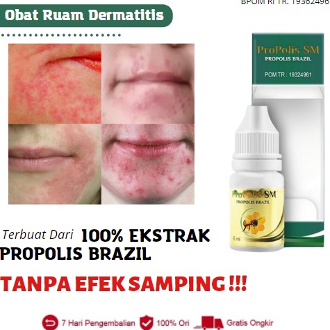 Jual Super Stock Obat Ruam Dermatitis Perioral Benjolan Kecil Merah Di ...