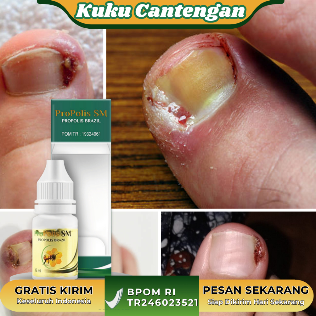 Jual Obat Kuku Cantengan, Obat Kuku Jempol Kaki Bengkak Berdarah dan ...
