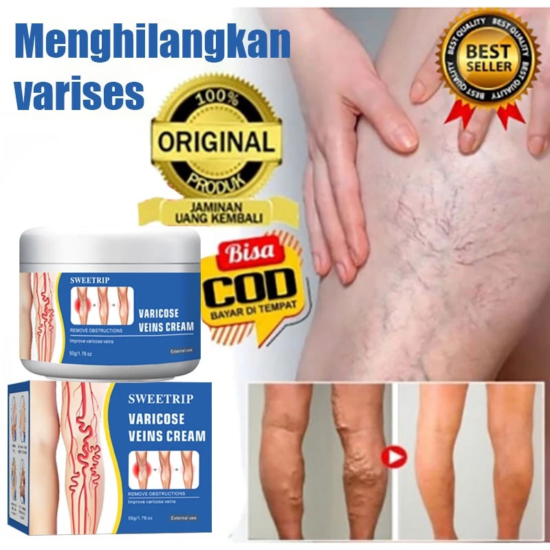 Jual Varicose Veins Cream Obat Varises Salep Penghilang Varises Paling ...