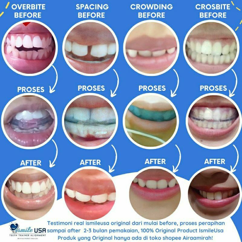 Jual Perapi Gigi - Teeth Trainer Allignment -garansi 100% ismileUSA ...
