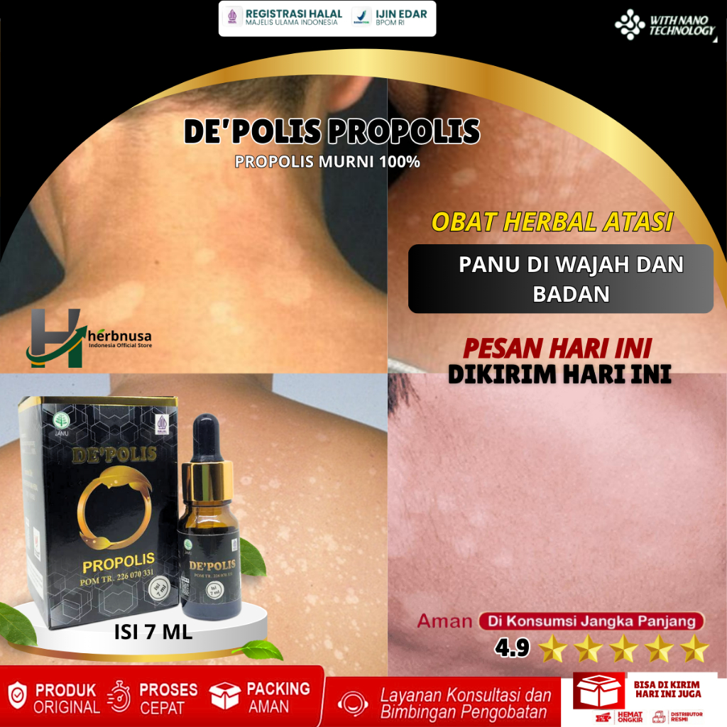 Jual Obat Panu Cair, Obat Panu Anak Dan Dewasa, Obat Penghilang Panu ...