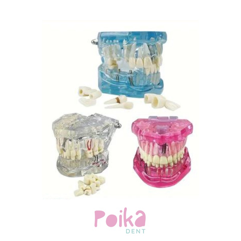 Jual Model Study Dental Transparan gigi bisa dilepas / Model edukasi ...