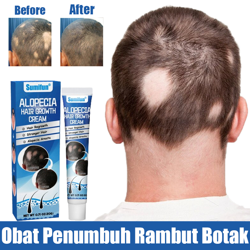 Jual Obat Alopecia Areata, Obat Penumbuh Rambut Botak, Obat Botak Koin ...