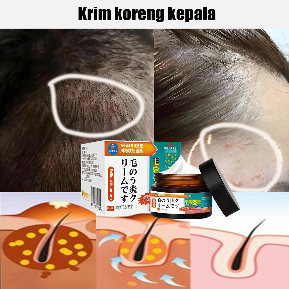 Jual obat krim Borok di Kepala krim Kepala Gatal, Tinea Kapitis,krim Jamur Kulit Kepala krim ...