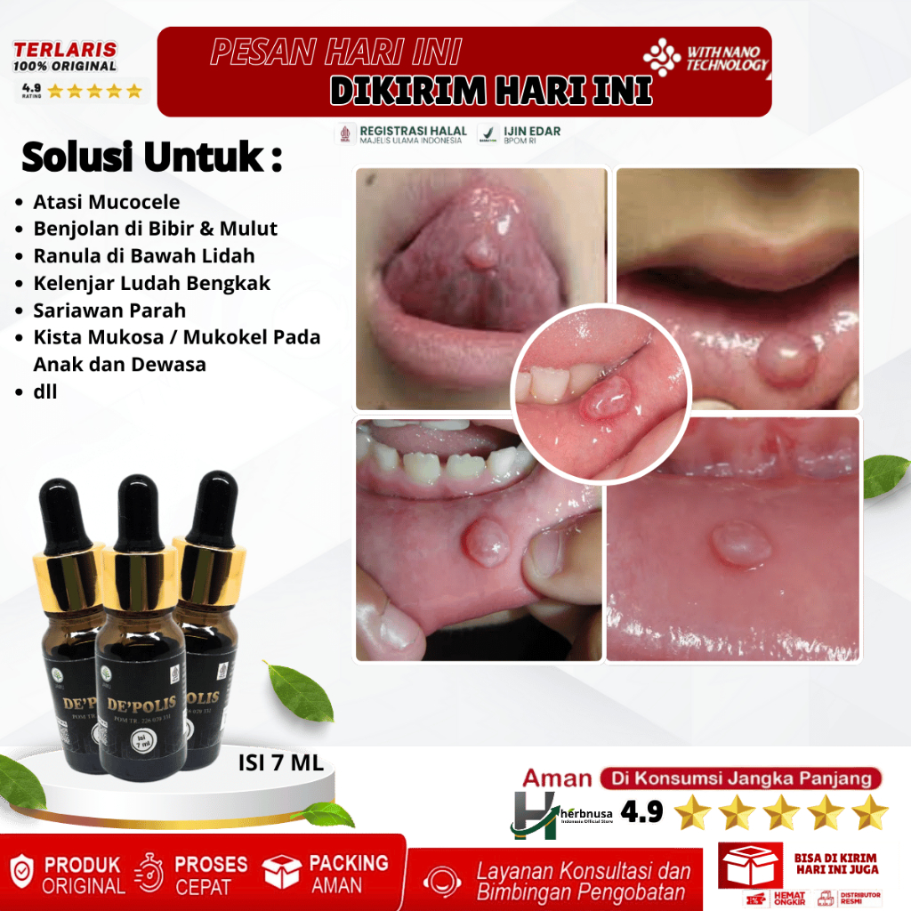 Jual Obat Mucocele, Obat Benjolan di Bibir & Mulut, Obat Ranula di ...