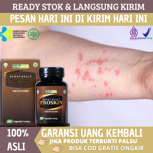 Jual Obat Gatal Bernanah, Obat Gatal Berair, Obat Cacar Air, Obat ...