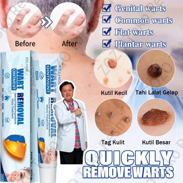 Jual Penghilang Kutil dan Tahi Lalat Penghilang Tahi Lalat untuk Wajah ...