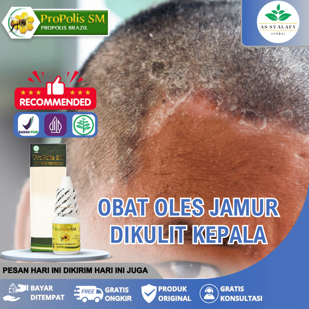 Jual Obat Jamur Kulit Kepala Tinea Capitis Koreng di Kepala Budug Di Kepala Borok Kulit Kepala ...