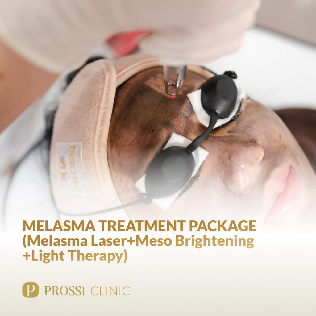 Jual Melasma Treatment Package (Melasma Laser + Meso Brightening ...