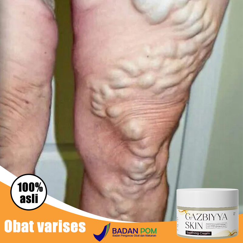 Jual [BPOM] Obat varises di kaki dan betis paling ampuh Obat varises ...