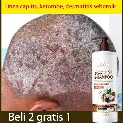 Jual shampoo anti dandruff shampoo shampoo psoriasis Anti Gatal perawatan rambut ketombe Garam ...