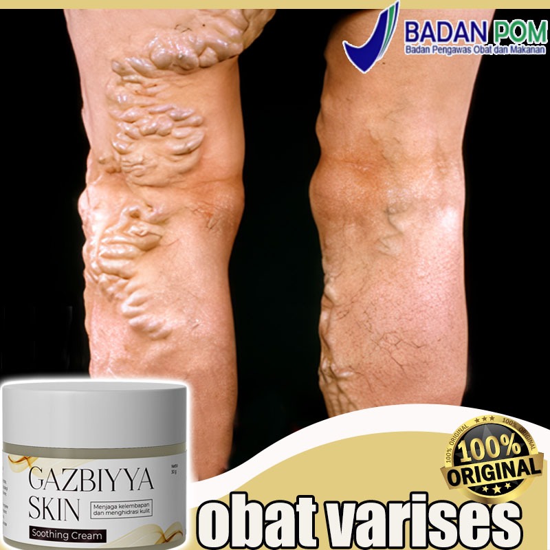Jual Obat varises Varicose veins cream Cream varises paling ampuh ...