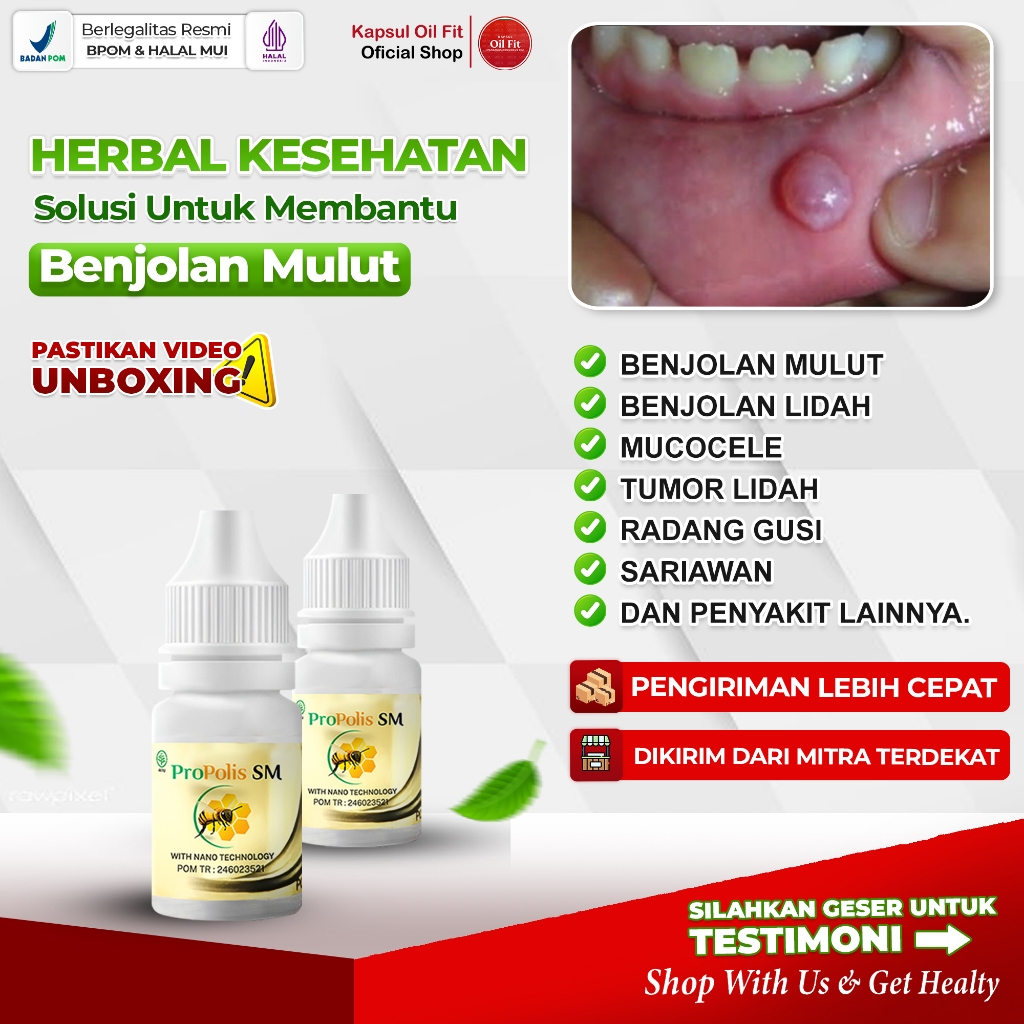 Jual Obat Benjolan Mulut Bibir Penghilang Benjolan Di Bawah Lidah Obat ...