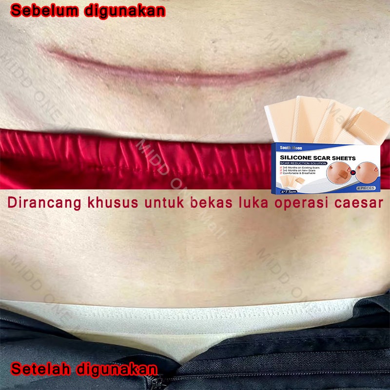 Jual silicone scar sheet penghilang bekas luka Keloid Plester ...