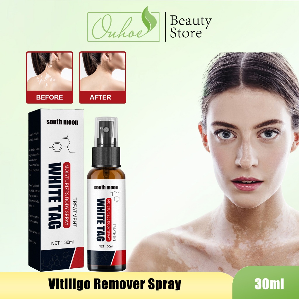 Jual 【100%ORI/COD】SOUTH MOON Vitiligo Remover Spray 30ml Kulit Belang ...