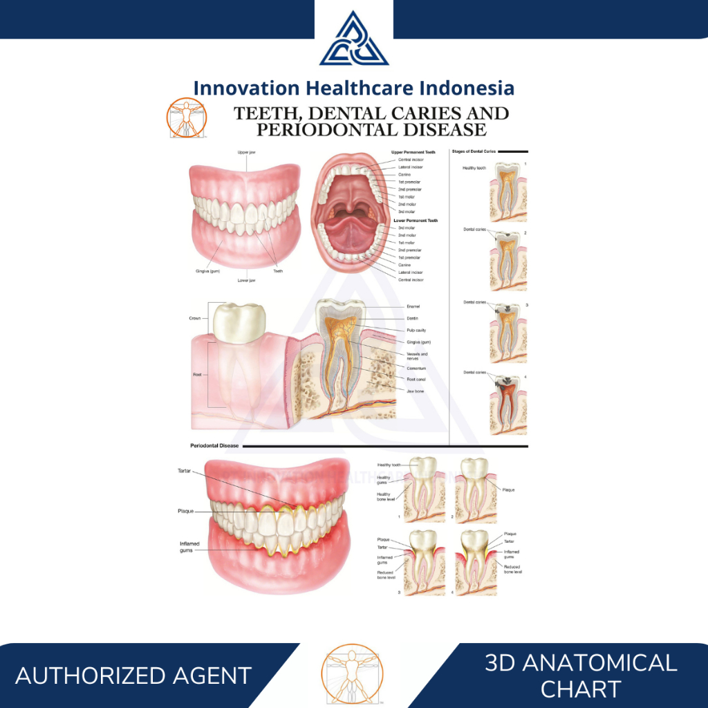 Jual 3D Anatomical Chart Teeth, Dental Caries and Periodontal Disease ...