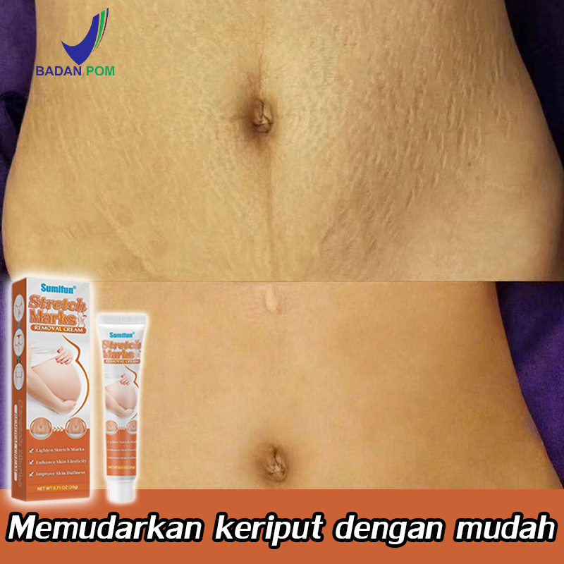 Jual Sumifun Krim penghilang keriput hamil 20g Stretch Marks Cream ...