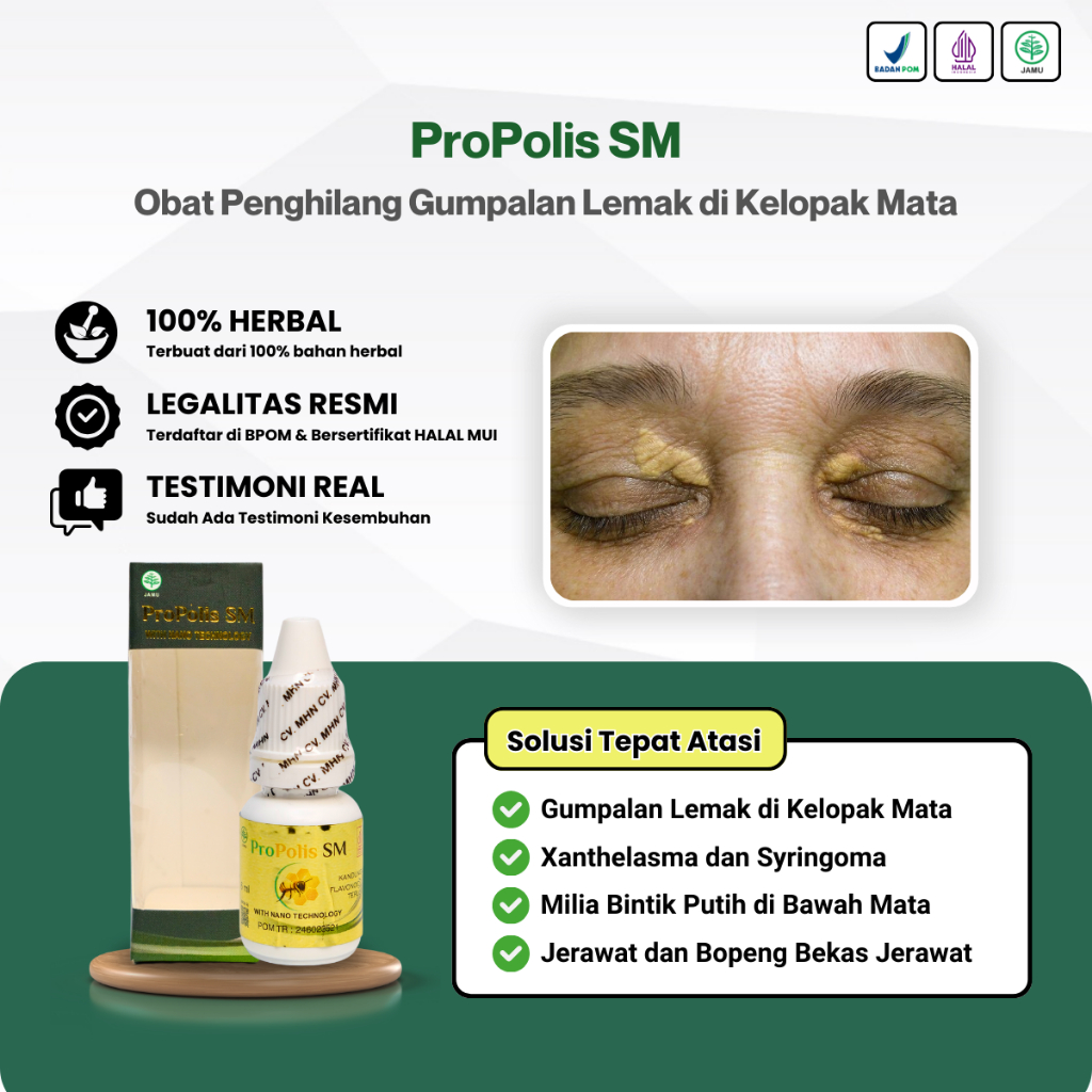 Jual Propolis SM - Obat Penghilang Gumpalan Lemak Di Kelopak Mata ...
