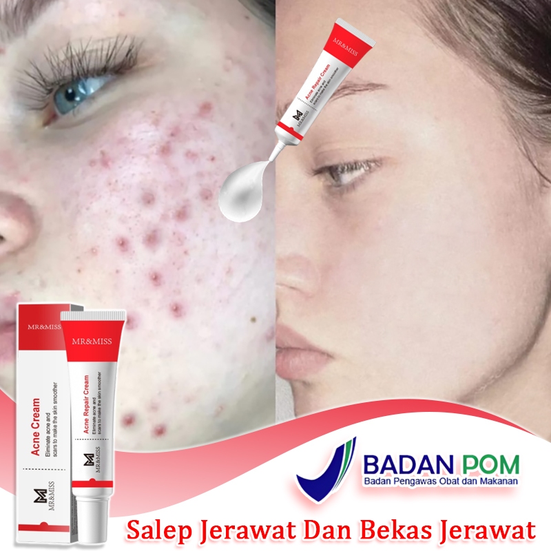 Jual Obat jerawat dan bekas jerawat penghilang bekas jerawat salep jerawat 20g obat jerawat ...
