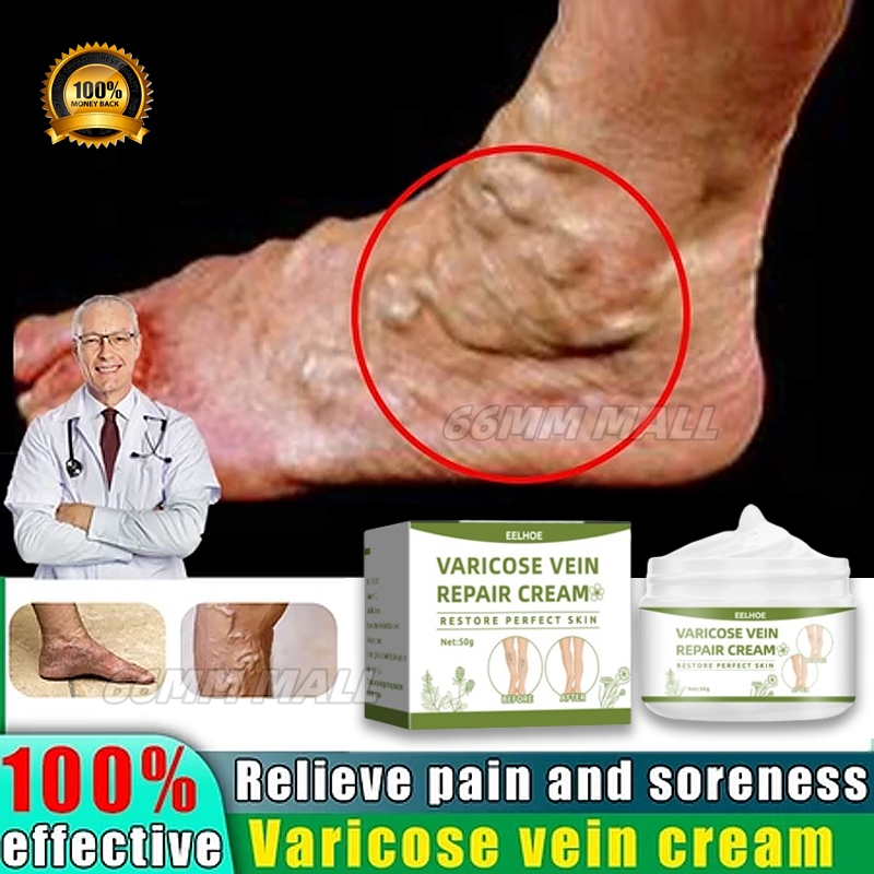 Jual obat varikokel salep varises 50g obat varises Varicose Veins Cream ...