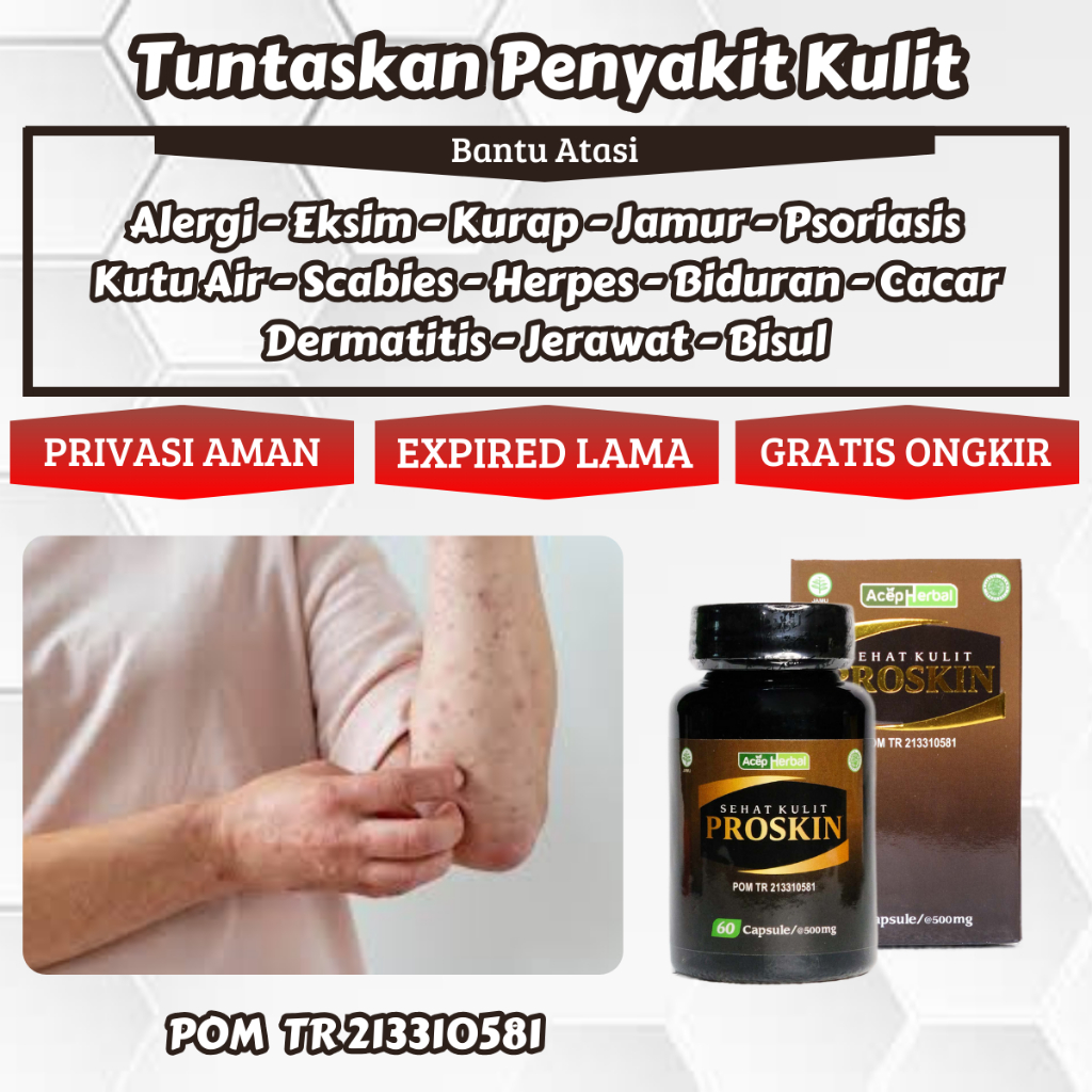 Jual PROSKIN Obat Scabies Jamur Kurap Eksim Psoriasis Kutu Air Alergi ...