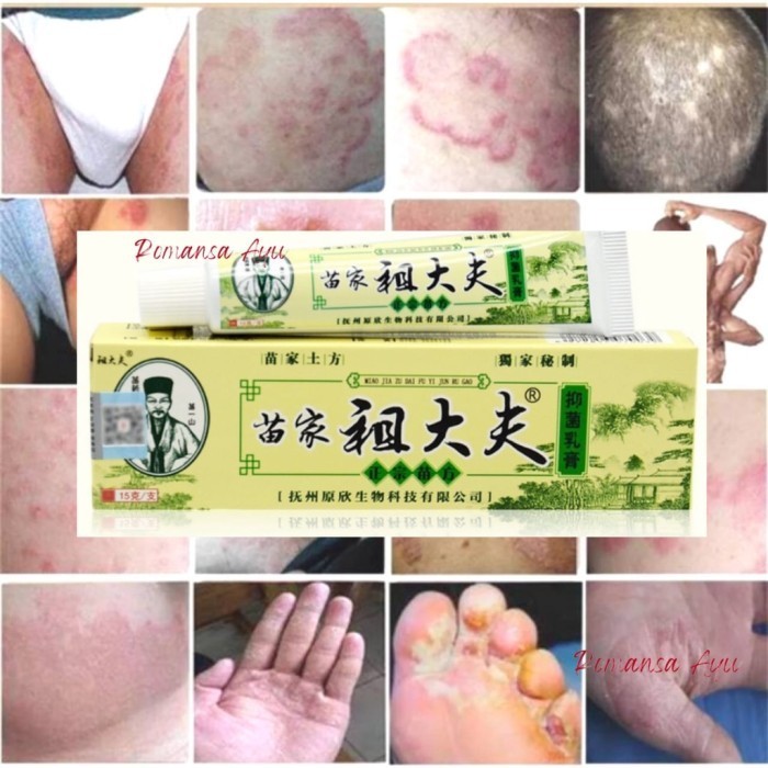 Jual ORIGINAL Salep Chy Gao Zudaifu Obat Cream Gatal Tubuh Gatal Exsim ...