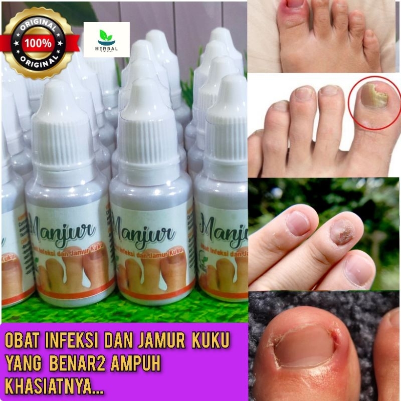 Jual OBAT kuku infeksi bakteri jamur gatal bau bernanah bengkak sakit ...