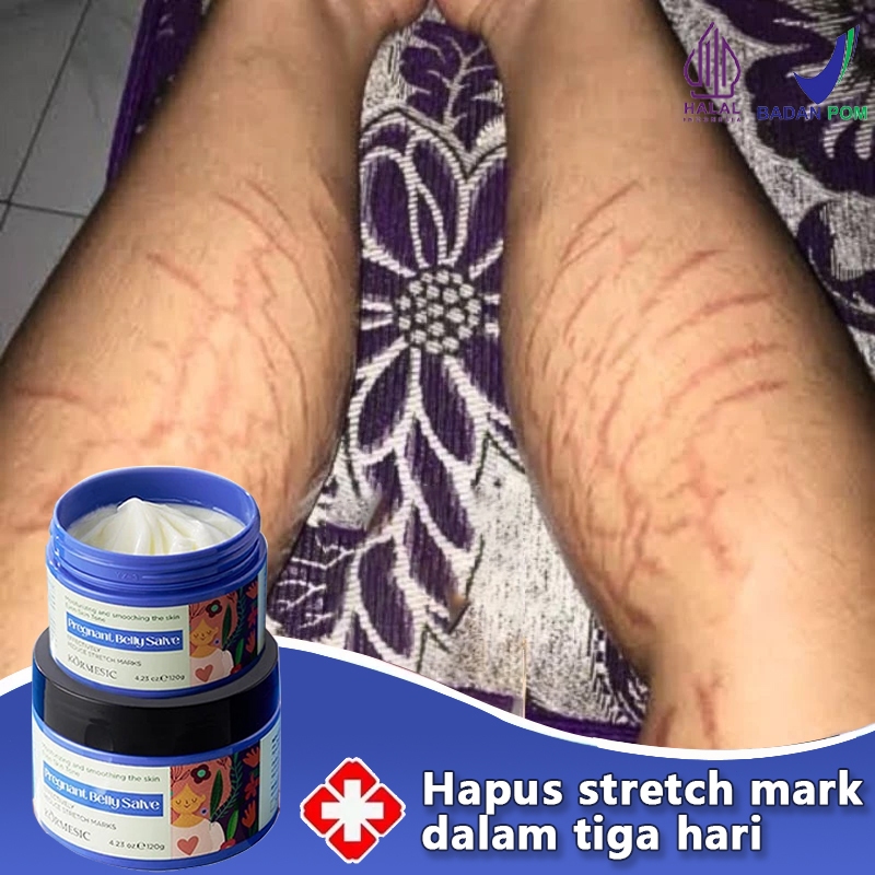Jual Krim Stretch Mark Herbal, efektif menghilang stretch mark, garis ...