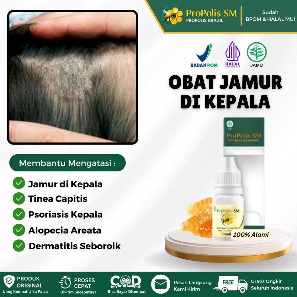 Jual Propolis SM - Salep Oles Untuk Jamur di Kepala, Tinea Capitis ...