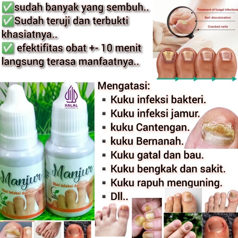 Jual NAIL SERUM kuku obat infeksi jamur dan bakteri Cantengan bau gatal ...
