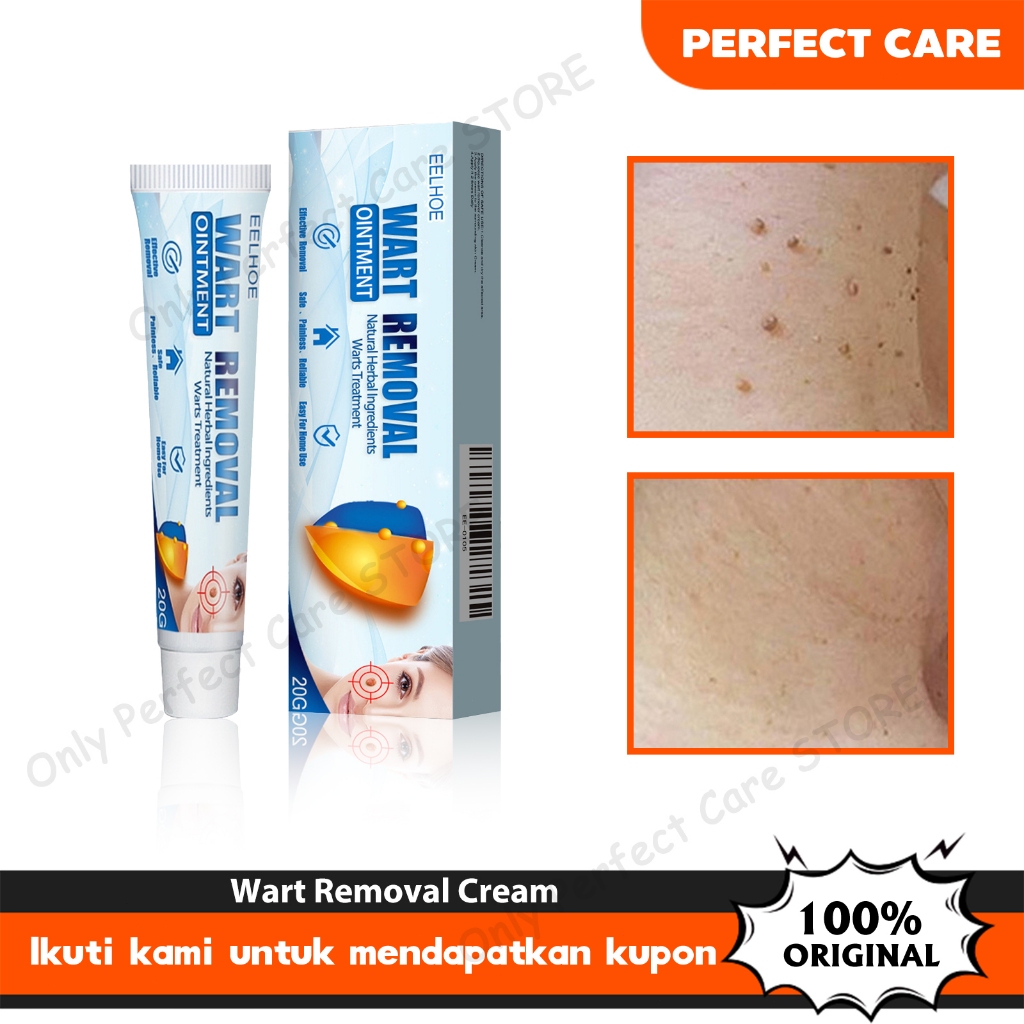 Jual EELHOE Wart Removal Ointment 20g Salep Penghilang Kutil Dan Tahi ...