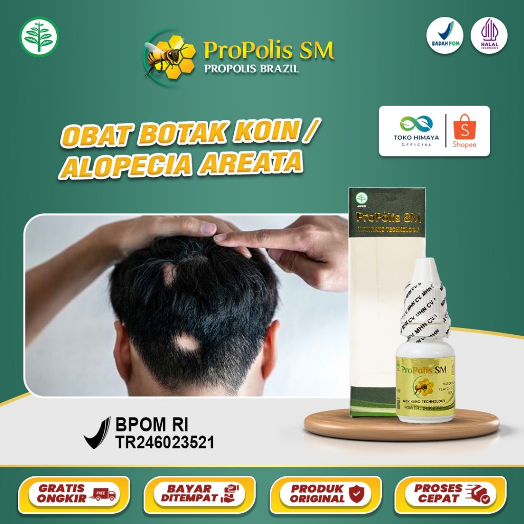 Jual Obat Alopecia Areata, Botak Koin, Penumbuh Rambut Pitak, Obat ...