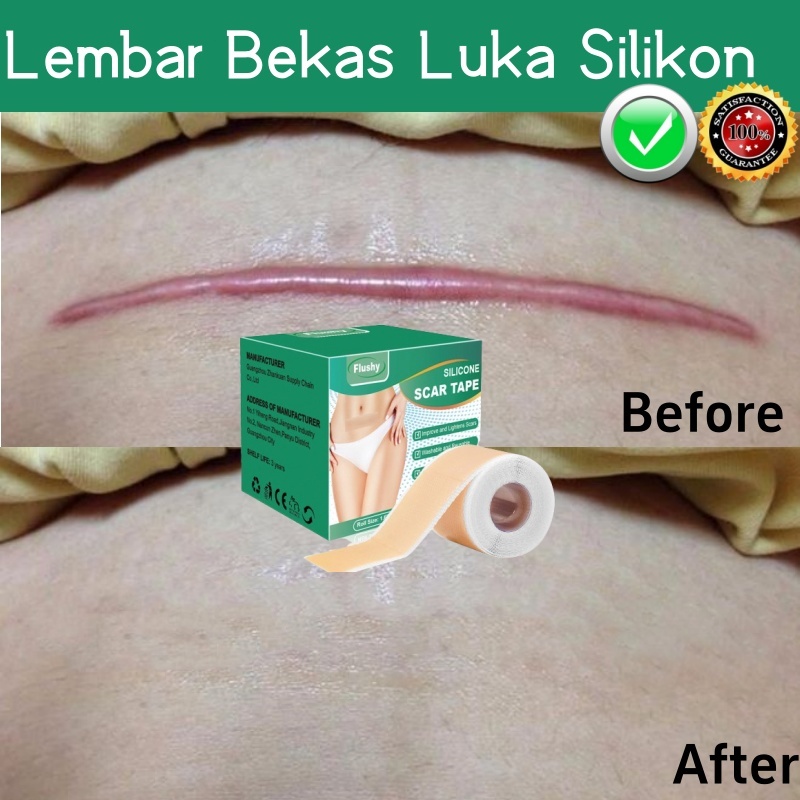 Jual Silicone scar sheet penghilang bekas luka 4cm x 150cm silicone ...