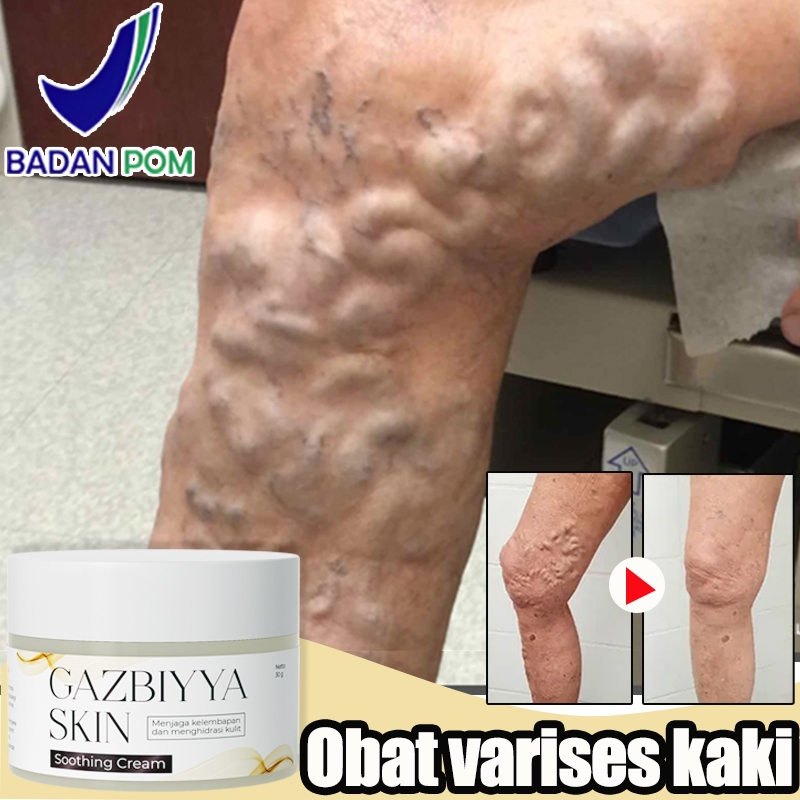 Jual {BPOM} Obat varises di kaki dan betis paling ampuh Obat varises ...