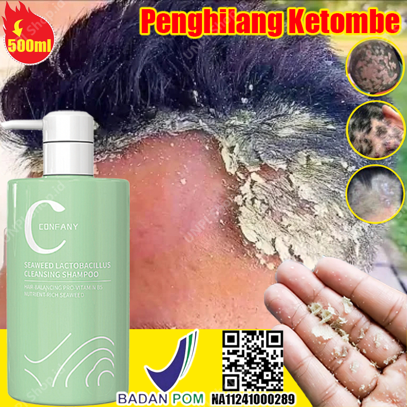 Jual Shampoo Anti Ketombe Dan Gatal Penghilang Ketombe Berkerak Dan Gatal Anti Dandruff Shampoo ...