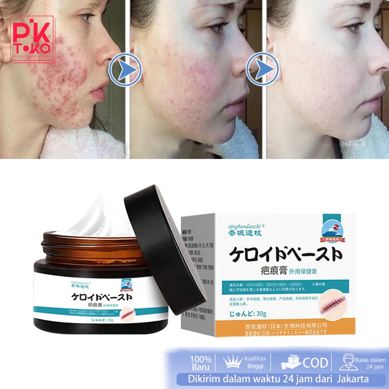 Jual Cream Penghilang Bekas Luka Hilangkan Bekas Luka Korengan Krim ...