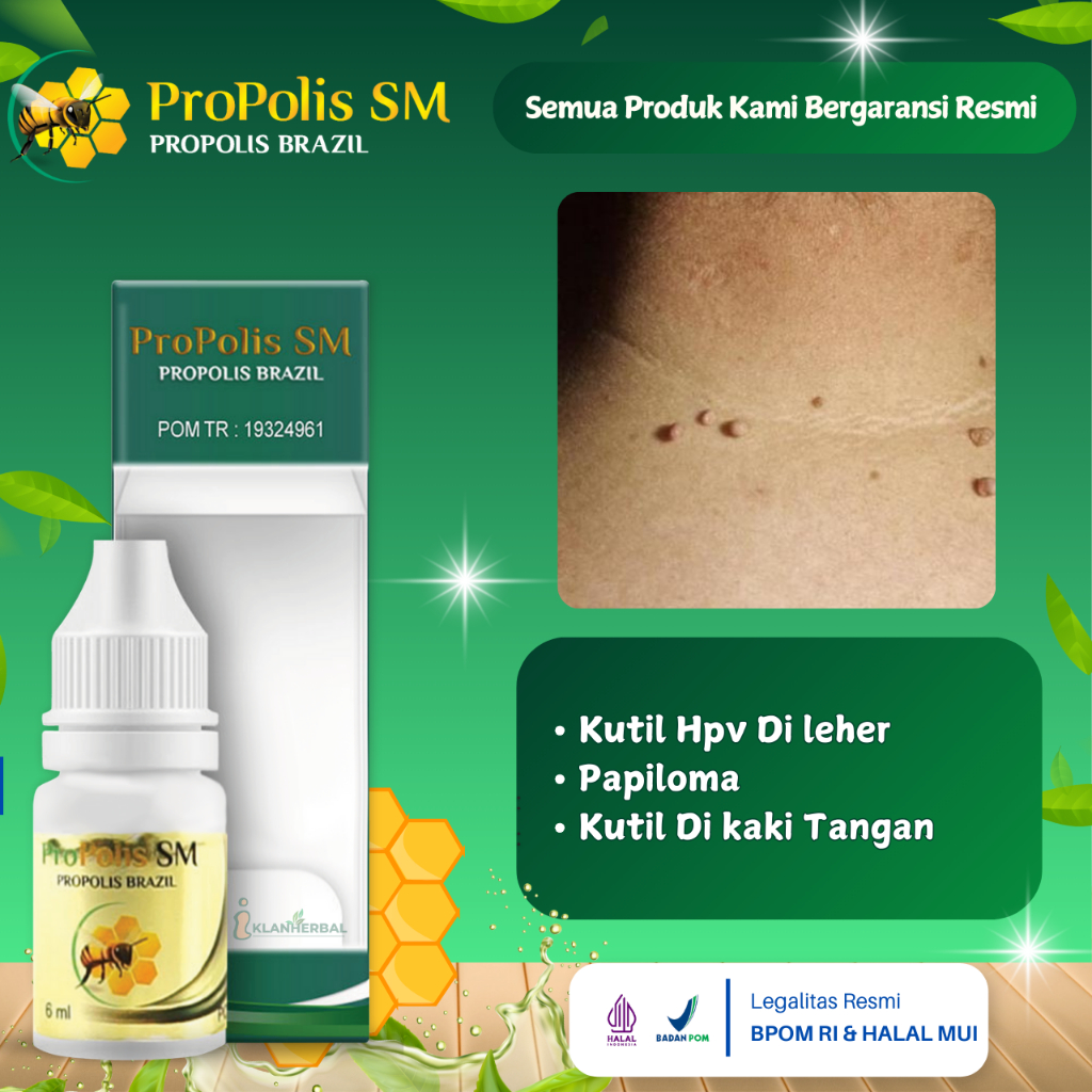 Jual Obat Penghilang Kutil Hpv Papiloma Di Leher Wajah Tangan Kaki ...
