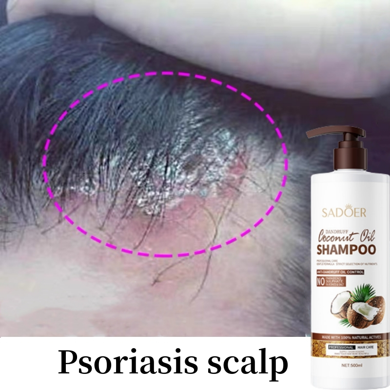 Jual Sampo anti ketombe Shampoo psoriasis Penghilang ketombe berkerak dan gatal Penghilang ...