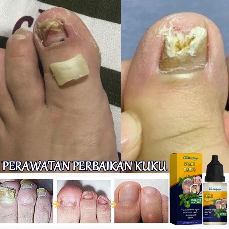 Jual Obat Jamur Kuku Perawatan Kuku Obat Kuku Jamur Dan Rusak ...
