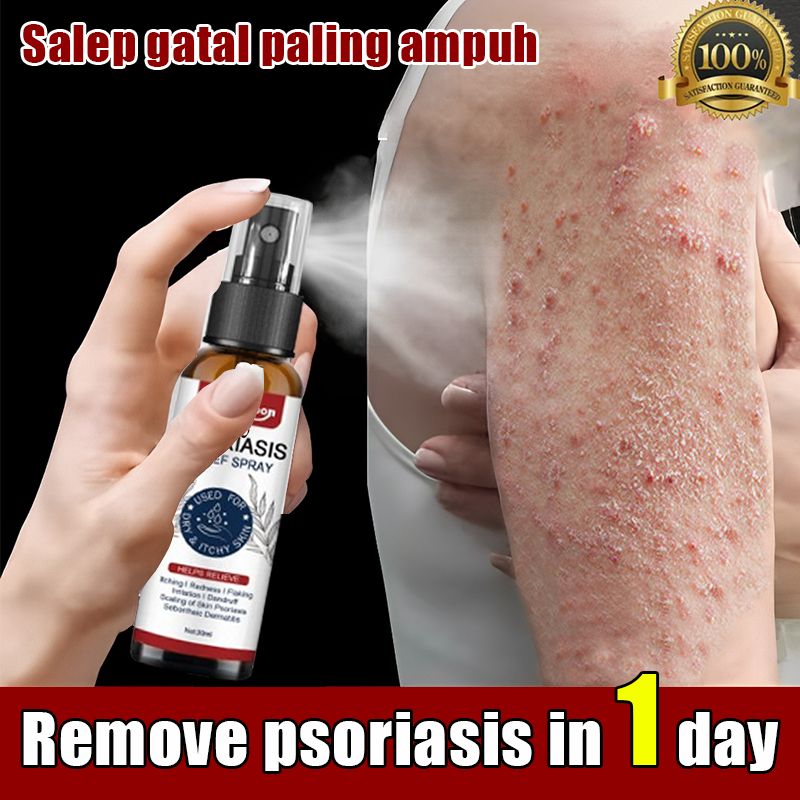 Jual 【100% Original】Salep gatal paling ampuh Obat psoriasis obat gatal ...