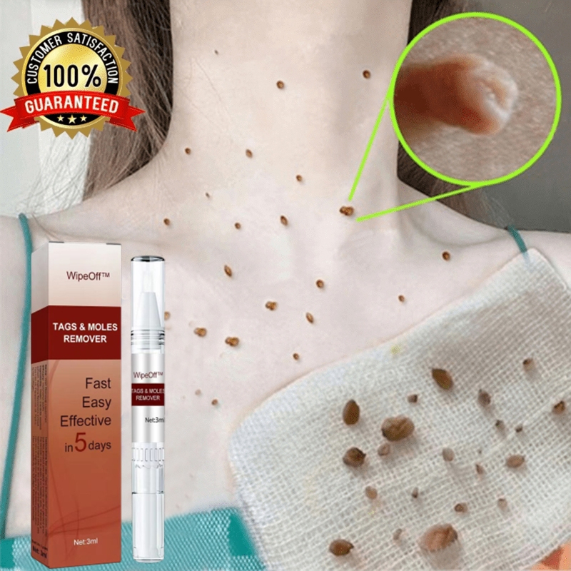 Jual Penghilang Kutil Di Wajah Penghilang tahi lalat di wajah Skin tag ...