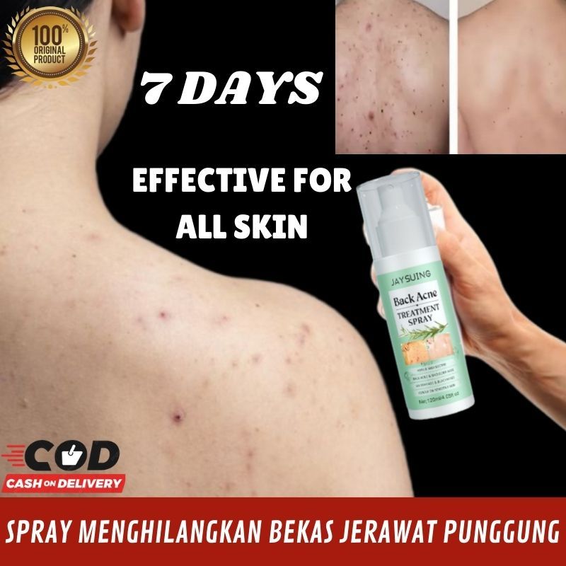 Jual Back Acne Spray Untuk Jerawat Punggung 10ml Back Acne Treatment ...
