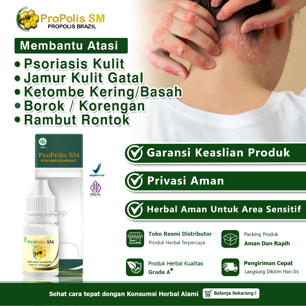 Jual Obat Herbal Psoriasis Gatal Jamur Kulit Kepala Anti Ketombe Basah Kering Kerak Tebal Gatel ...