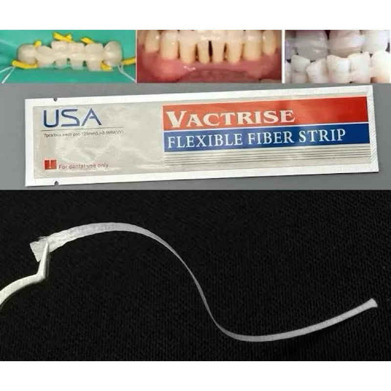 Jual Dental Fiber Splinting Splint Strip Endo / splinting | Shopee ...