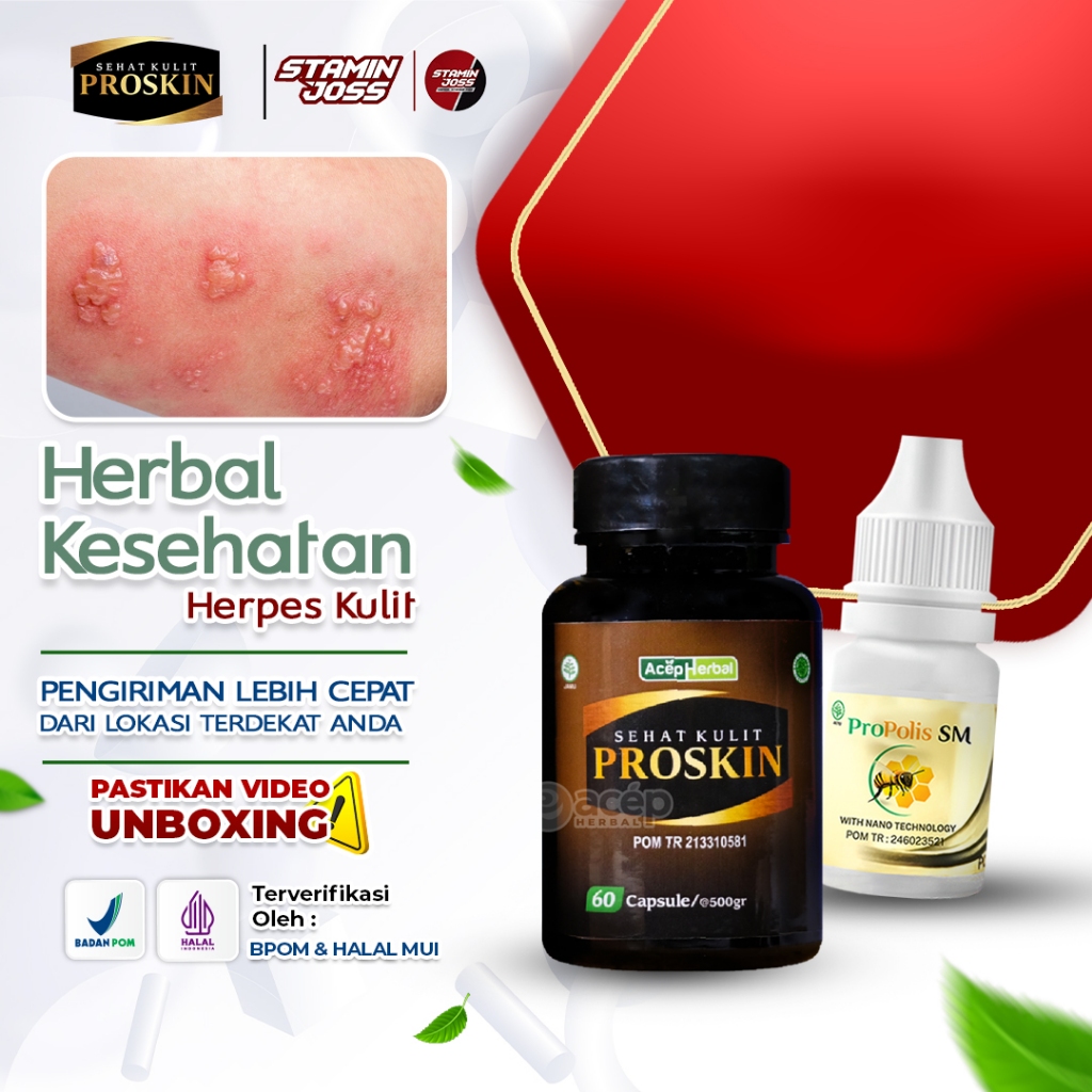 Jual Obat Salep Herpes Genital Herpes Zoster Herpes Bibir Gatal Seluruh ...