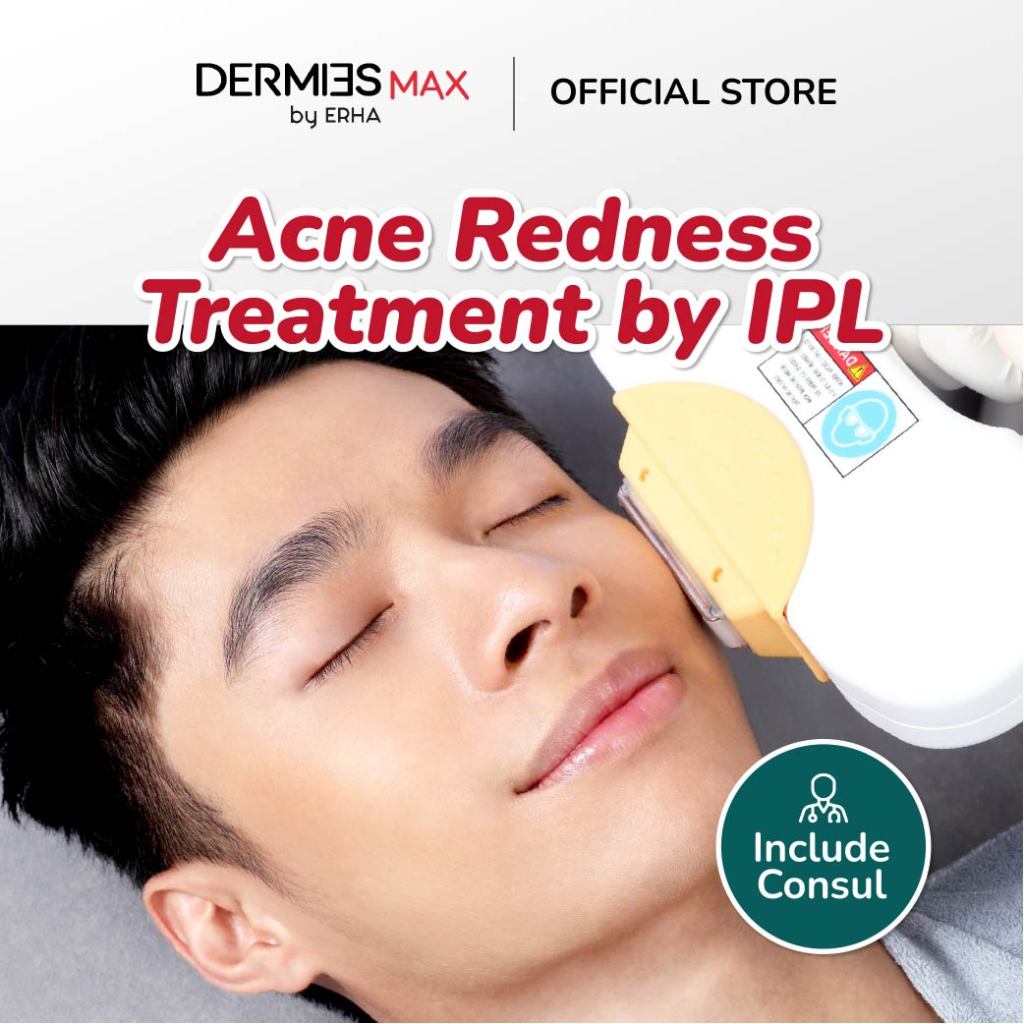 Jual Dermies Max Acne Redness Treatment By IPL | Shopee Indonesia